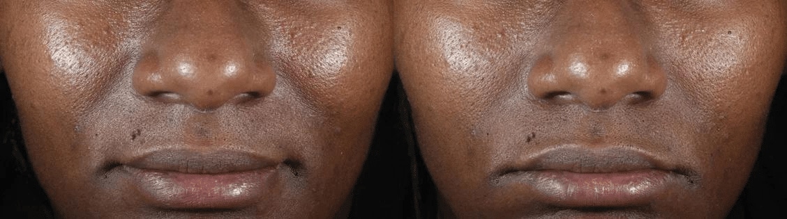 DiamondGlow Denver CO - DiamondGlow Facial Aurora CO